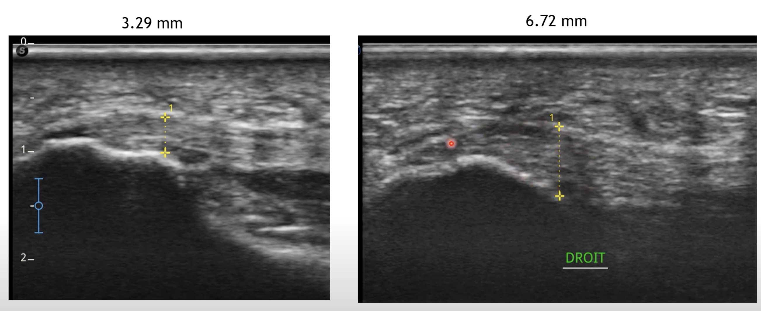 Echographie de l'aponévrose plantaire