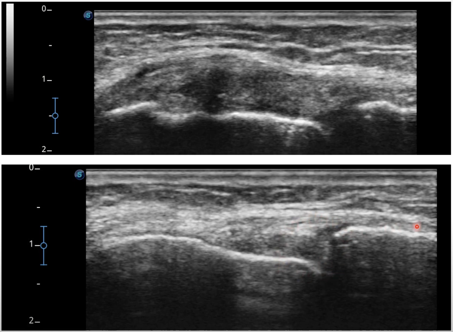 Echographie d'une entorse médiale du genou