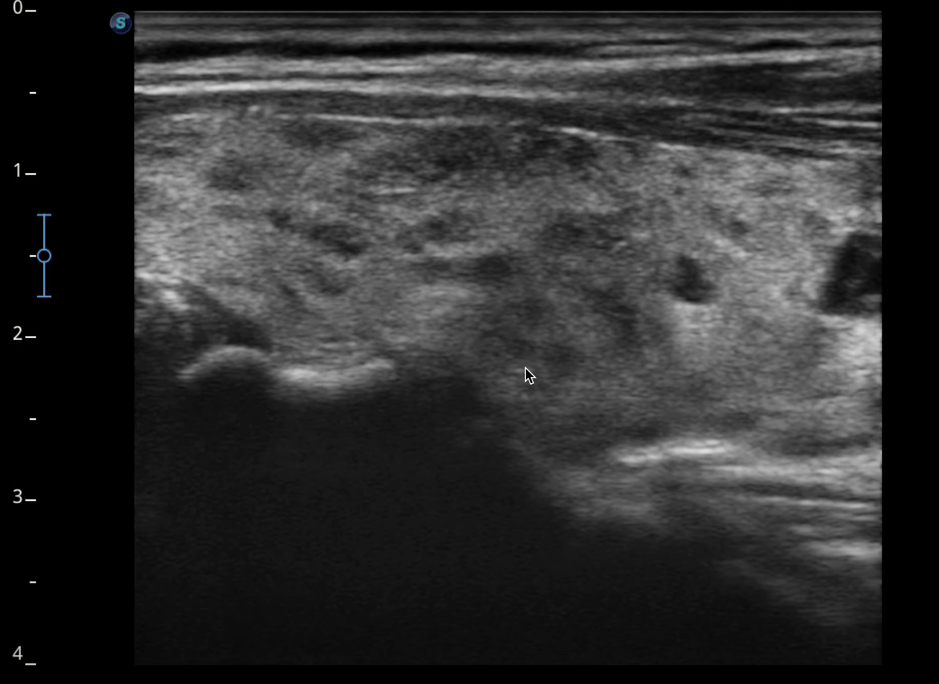 "Peau de Leopard": thyroidite de Hashimoto en échographie