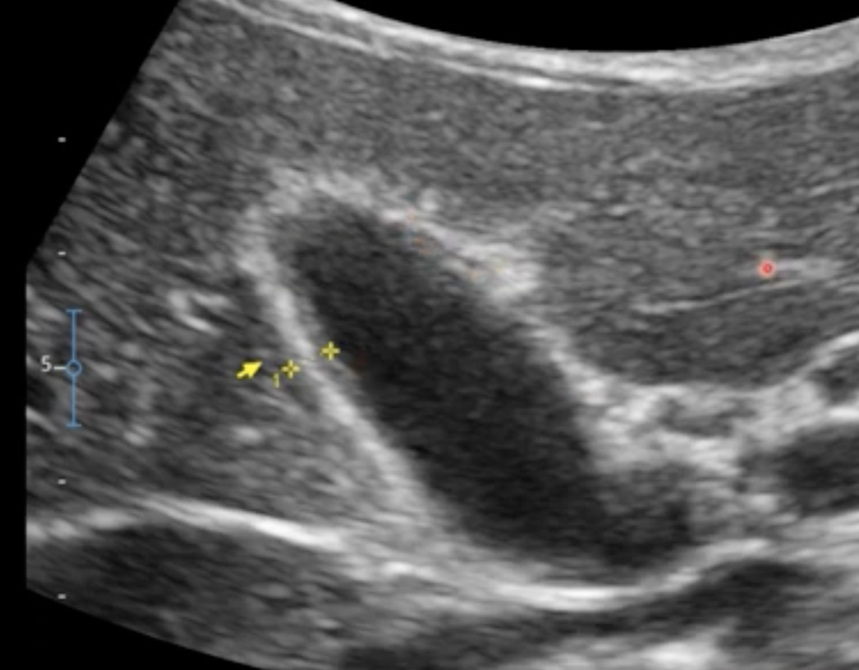 Lithiase vésiculaire et aspect feuilleté en échographie