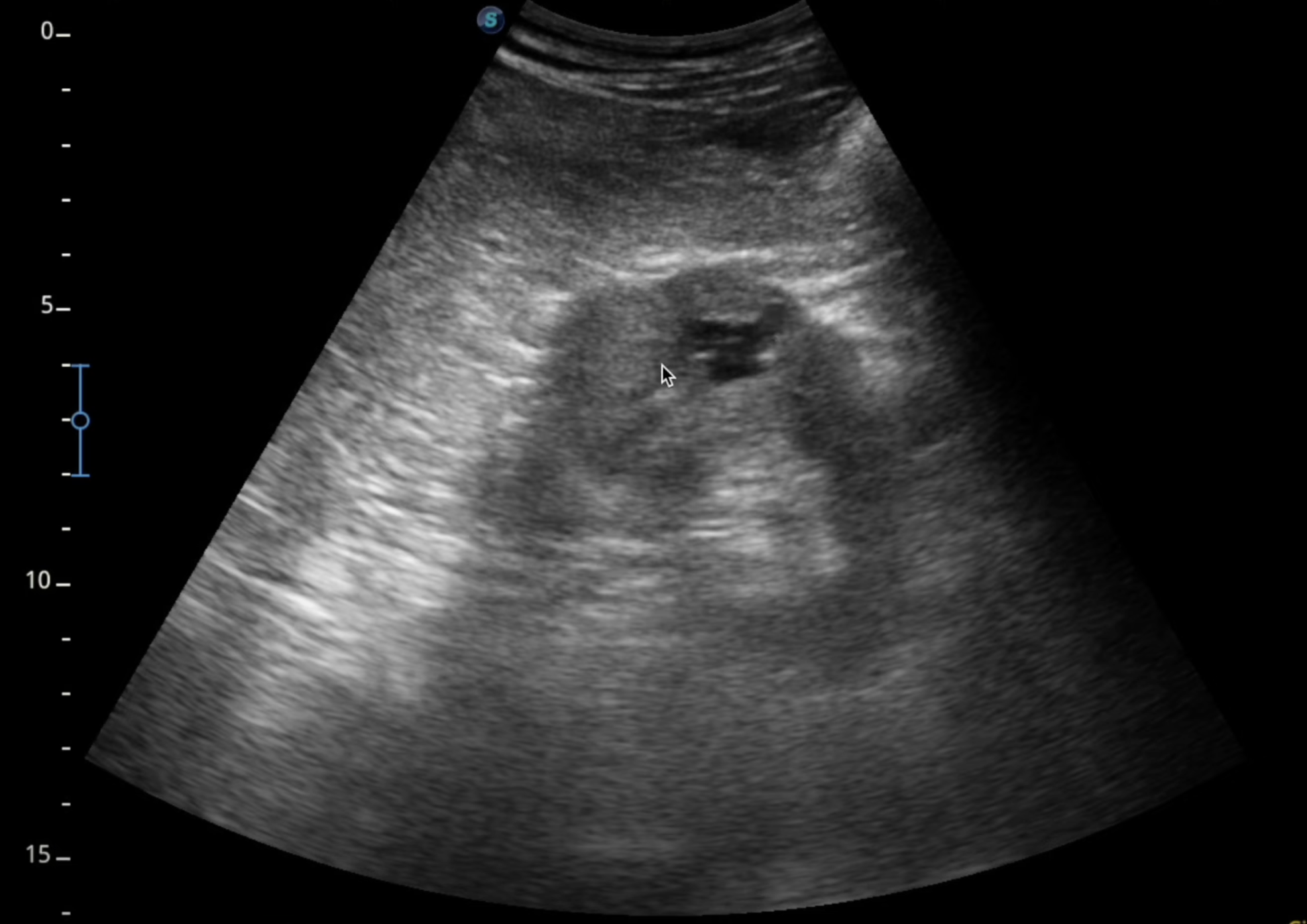 Exploration d'un kyste rénal en échographie: une image atypique