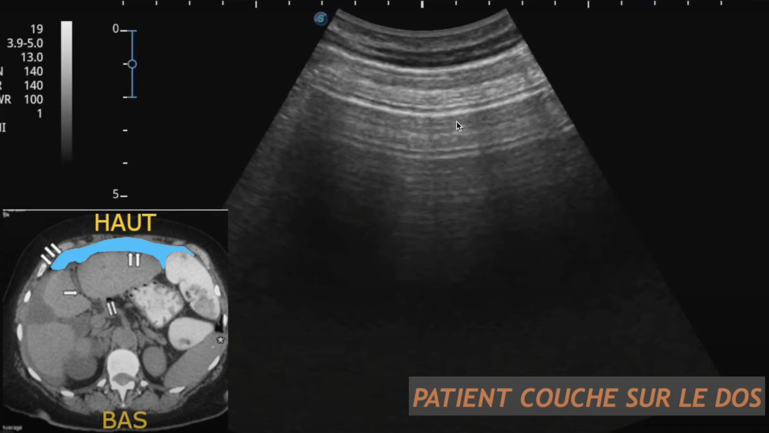 Aspect du pneumopéritoine en échographie