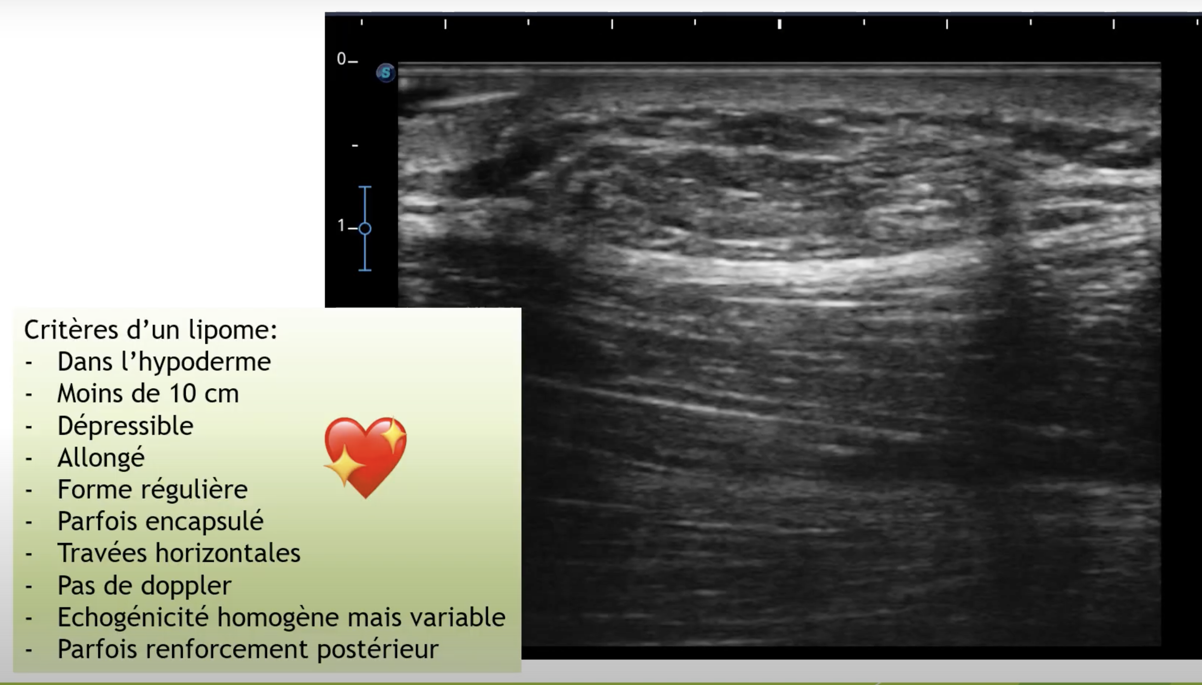 Les 10 critères échographiques d'un lipome