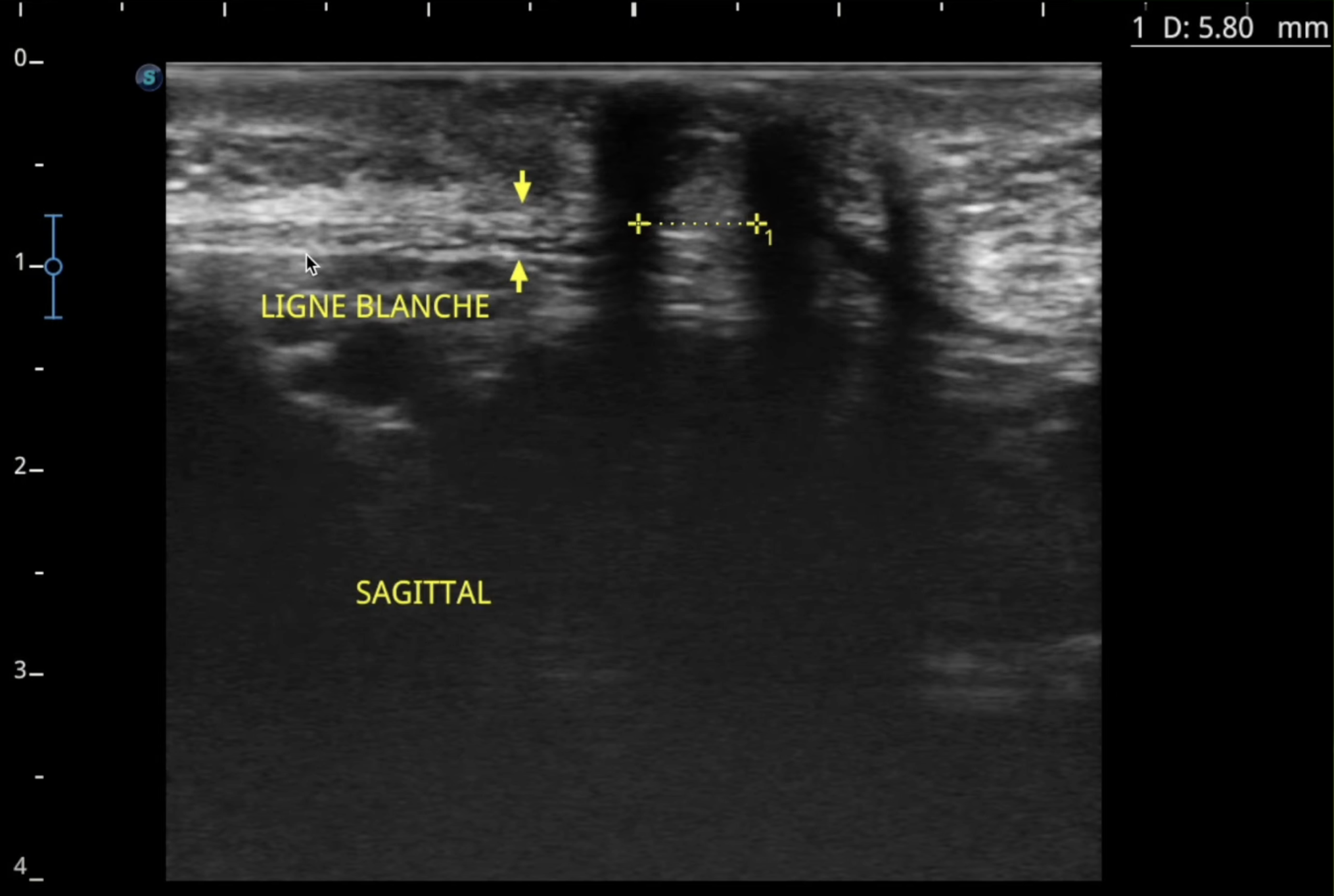 Hernie ombilicale en échographie: la trouver à coup sûr!
