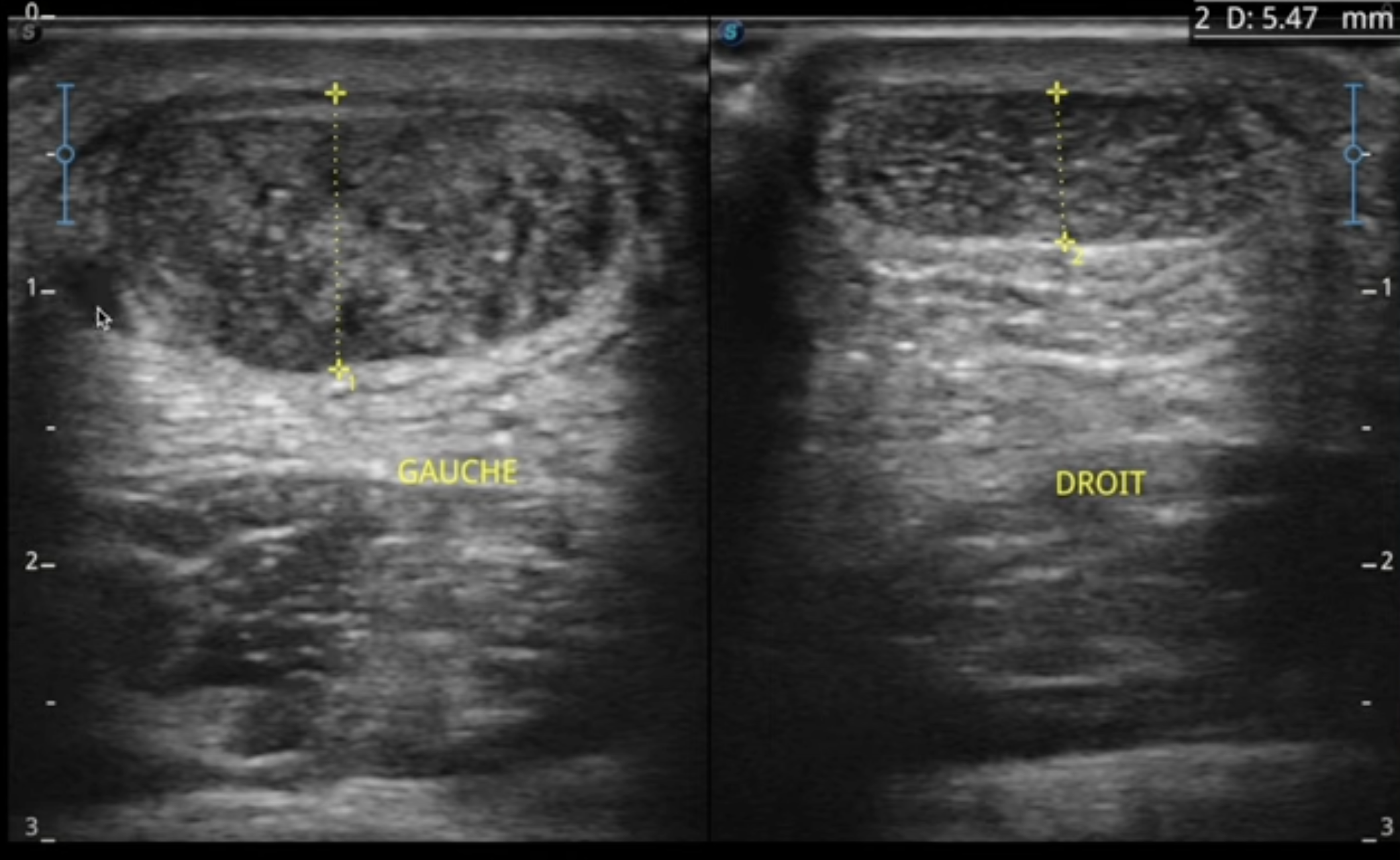 Tendinite fusiforme du tendon d'achille en échographie