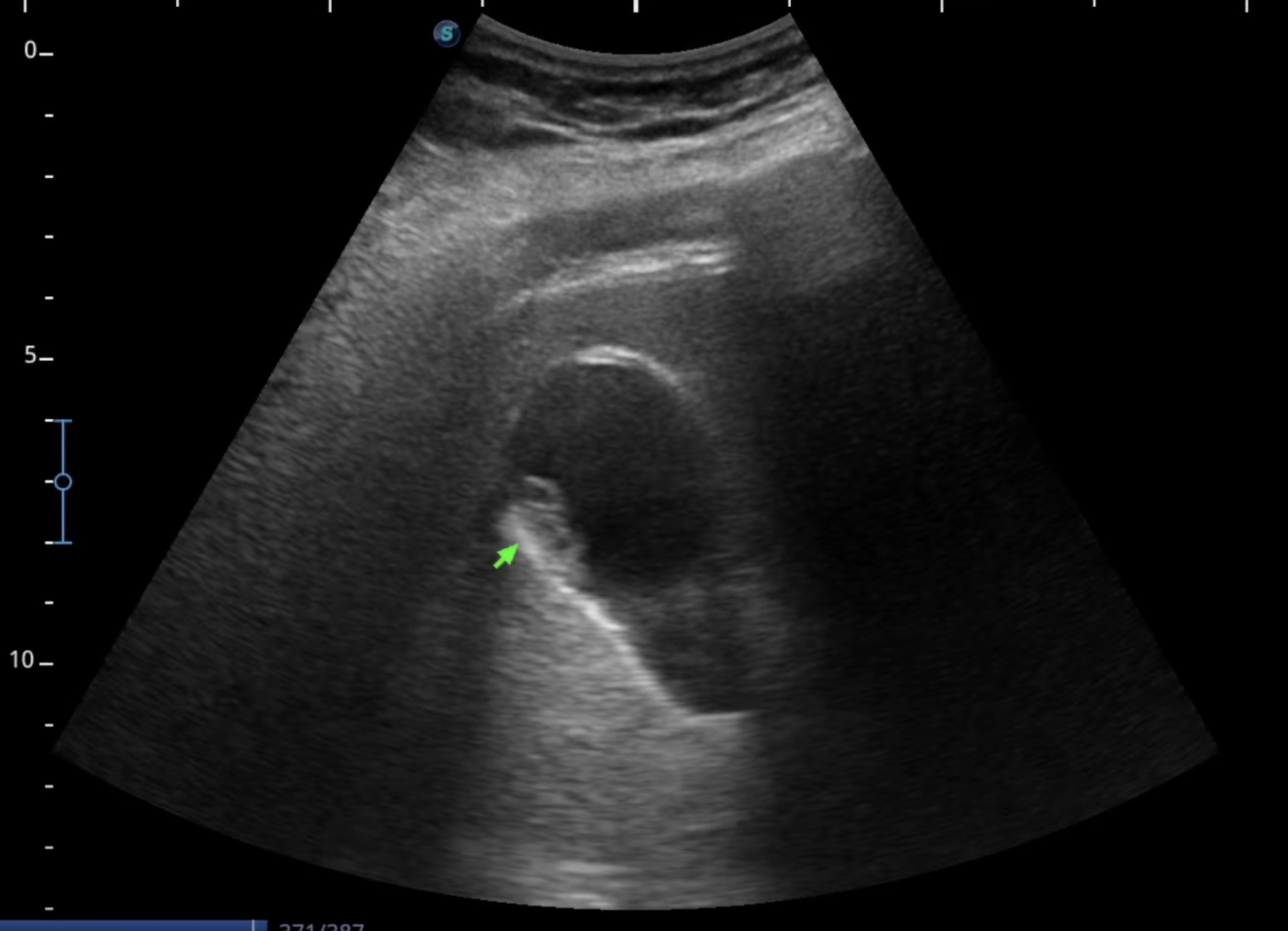 Polype ou sludge? Attention au piège en échographie de la vésicule ...